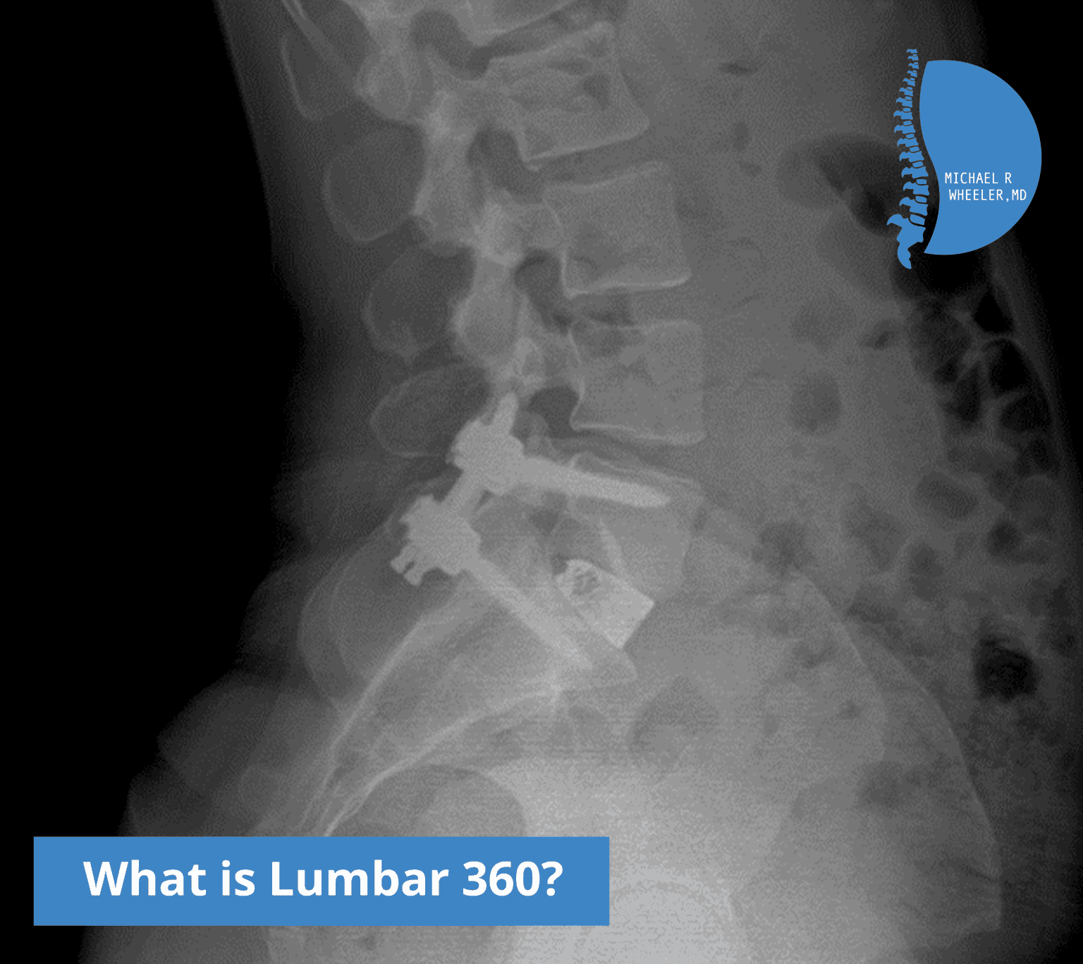Orthopedic Spine Surgeon Dallas | Michael R. Wheeler, MD