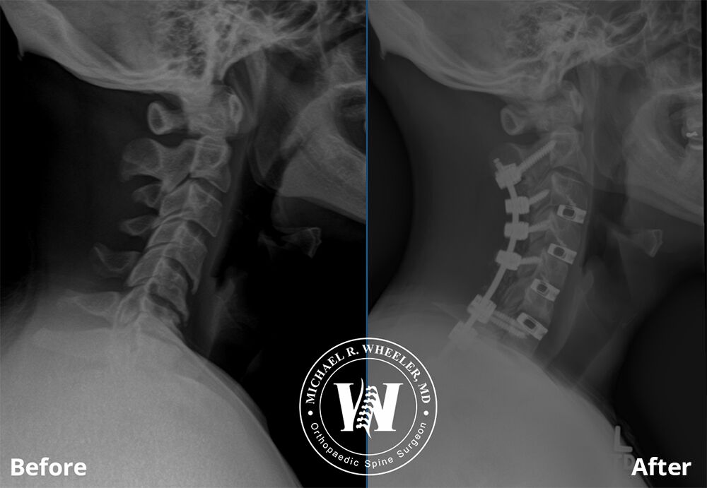 Dallas Posterior Cervical Fusion | Michael R. Wheeler, MD